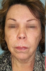 Nonsurgical Skin Rejuvenation with Fractora | Micro-Needling RF