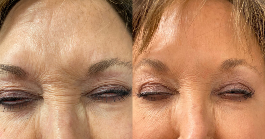 Botox & Dysport in Alabama and Florida | K2 Restorative Medicine