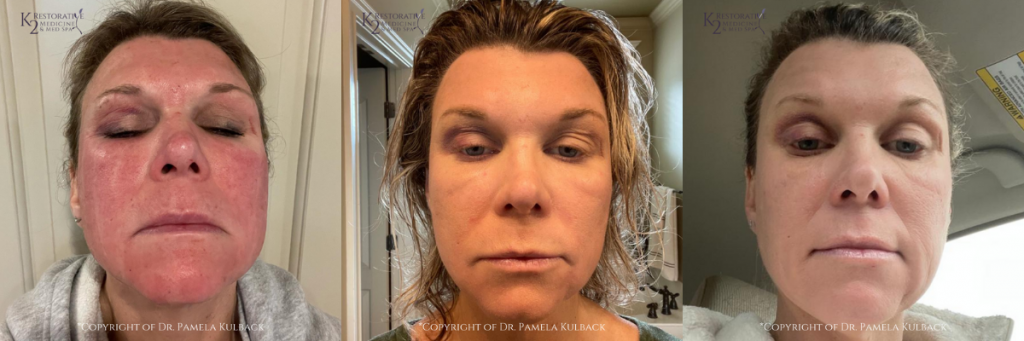 Tetra Co2 Laser & CoolPeel™ - K2 Restorative Medicine & Med-Spa Dr ...