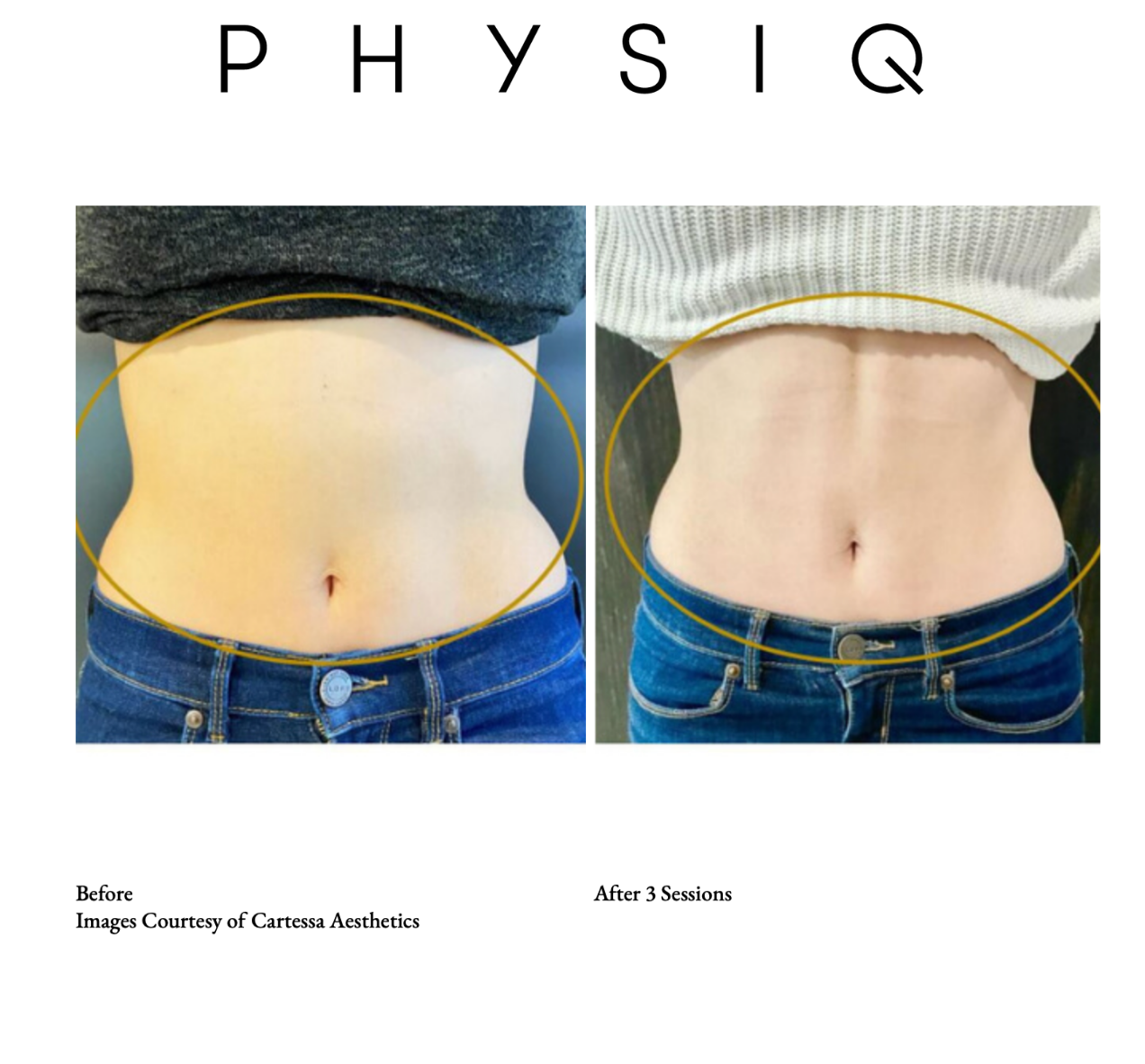 PHYSIQ 360 Body Contouring | Target Fat & Stimulate Muscle