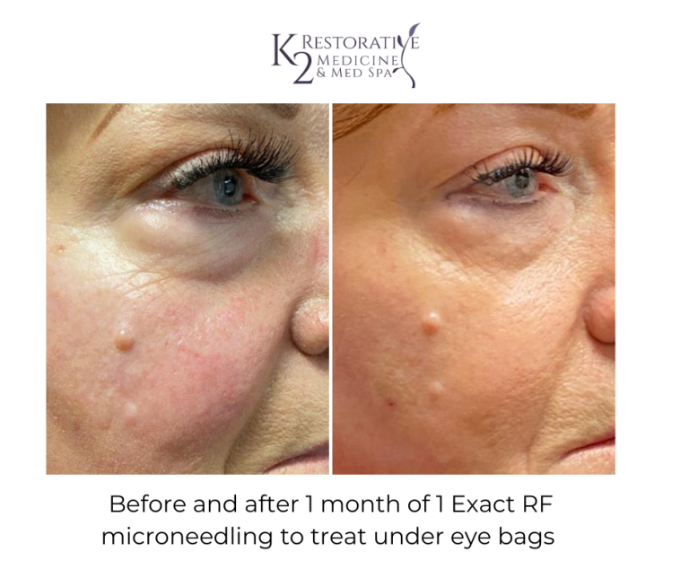 Virtue RF Microneedling | Face & Body Skin Rejuvenation