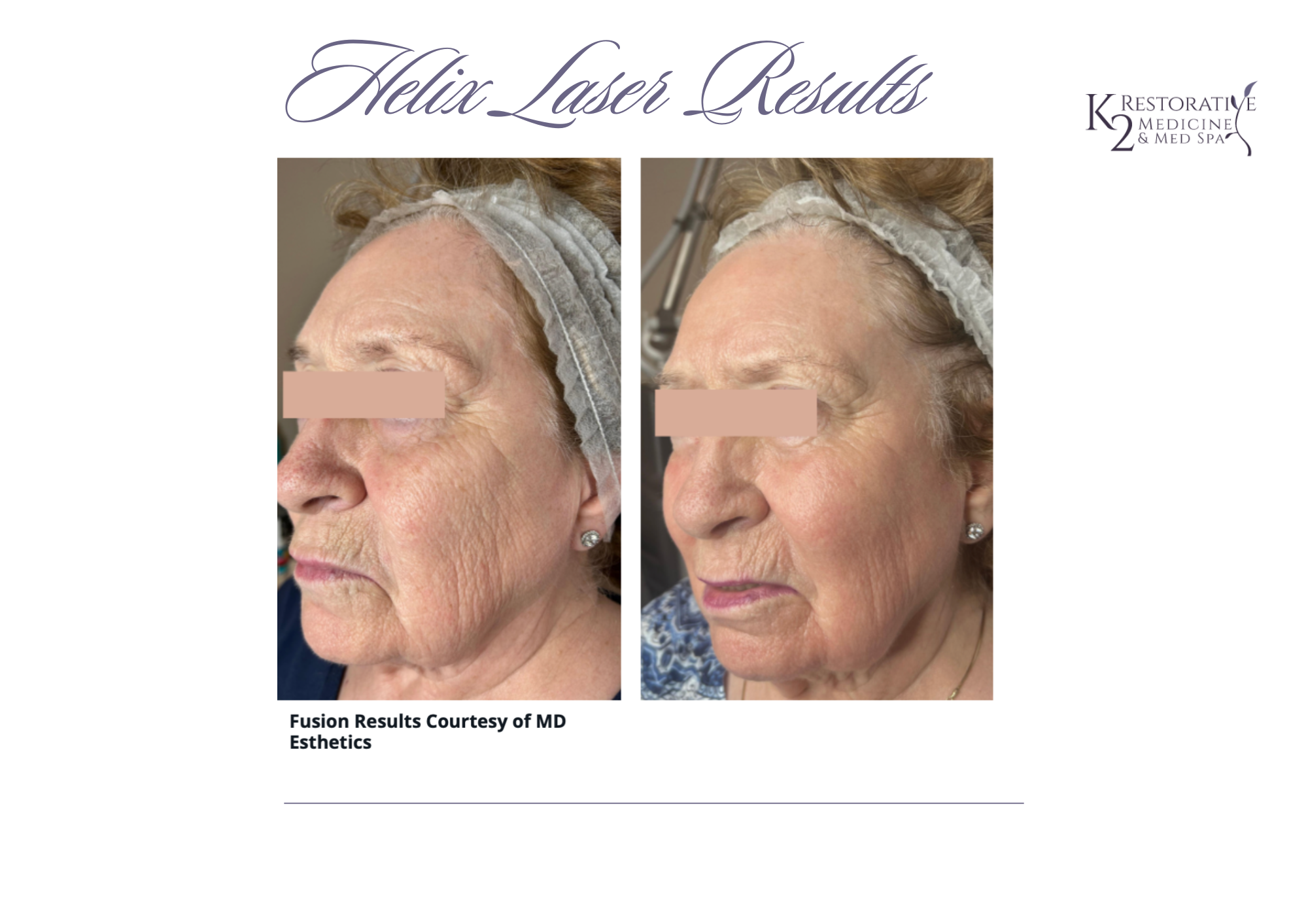 Helix - Laser Skin Resurfacing at K2 Medicine - Trussville, AL